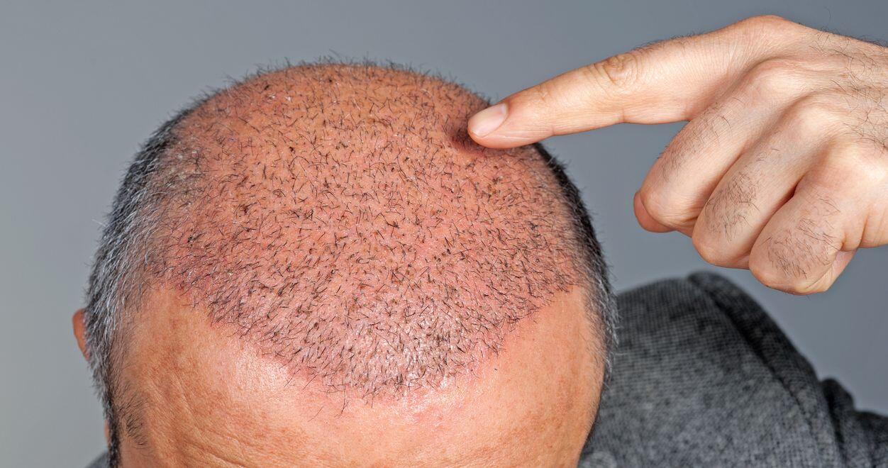 Sfaturi de urmat despre ce sa nu faci dupa implantul de par | Dr Felix Hair