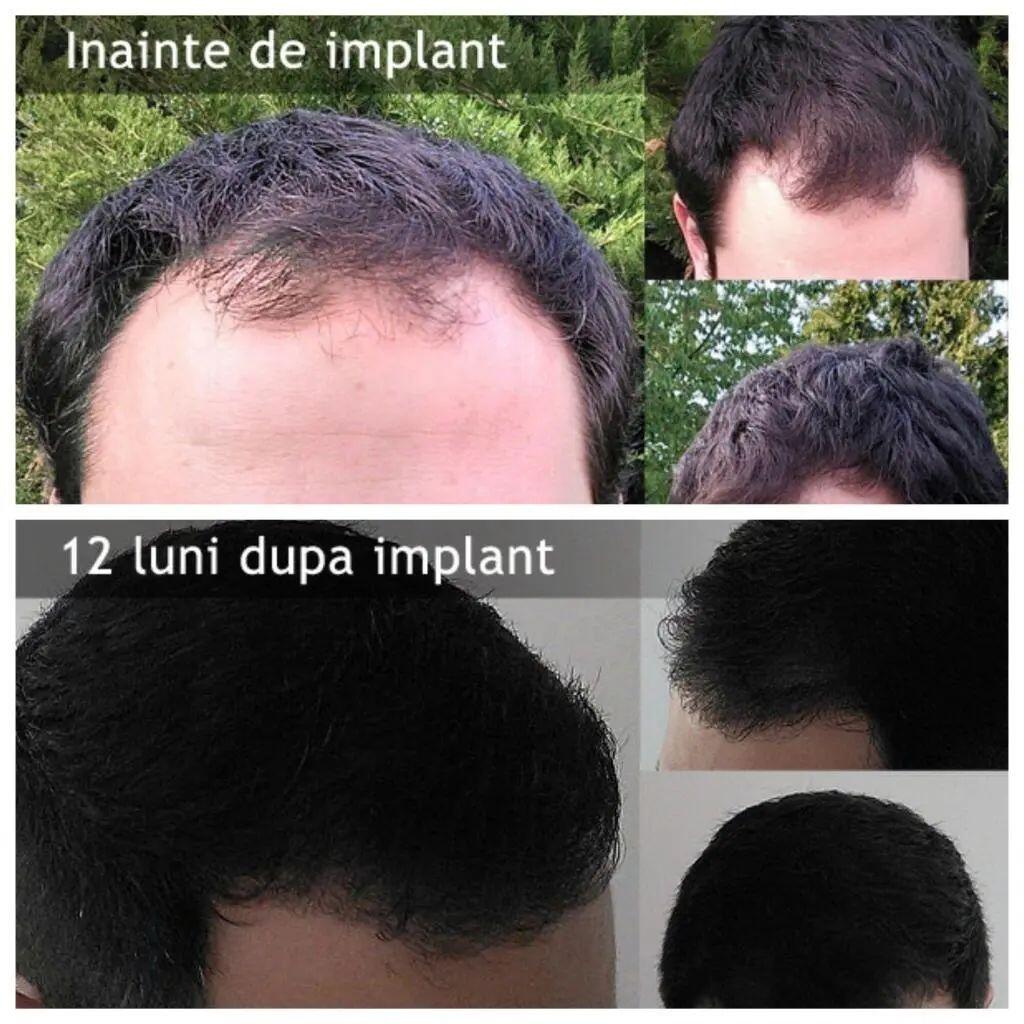 Etapele implantului de par si evolutia luna de luna dupa operatie! - Dr ...